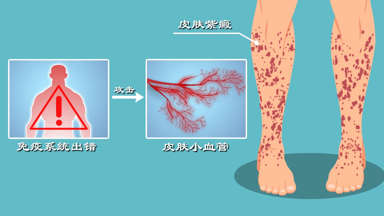 What are the different types of purpura? - iNEWS