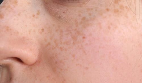 What to do if a woman has spots on her face? Usually do these things ...