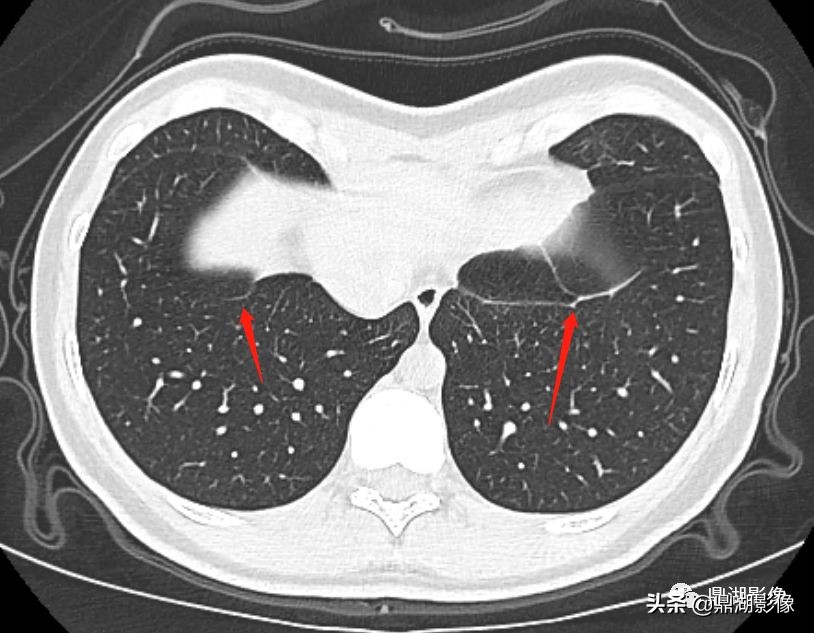 "Pulmonary ligament" on chest CT, stop reporting fibrous cords - iNEWS