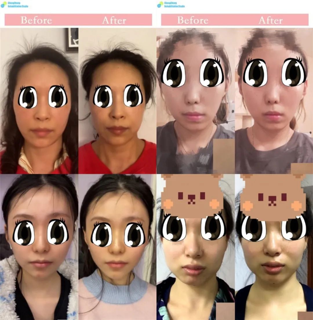 What kind of facial problems can be corrected by exercise? - iNEWS