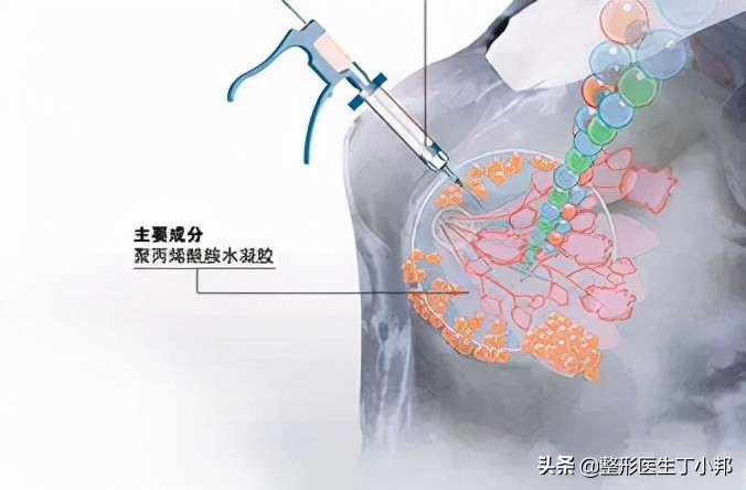 The injection breast augmentation 20 years ago has now become a "time ...