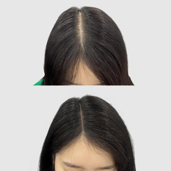 The latest anti-hair loss technology to help you grow hair in 3 months ...