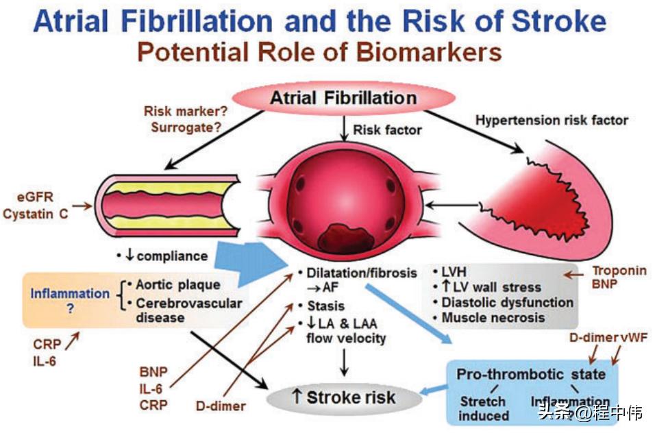 Risk stratification of stroke in atrial fibrillation - iNEWS