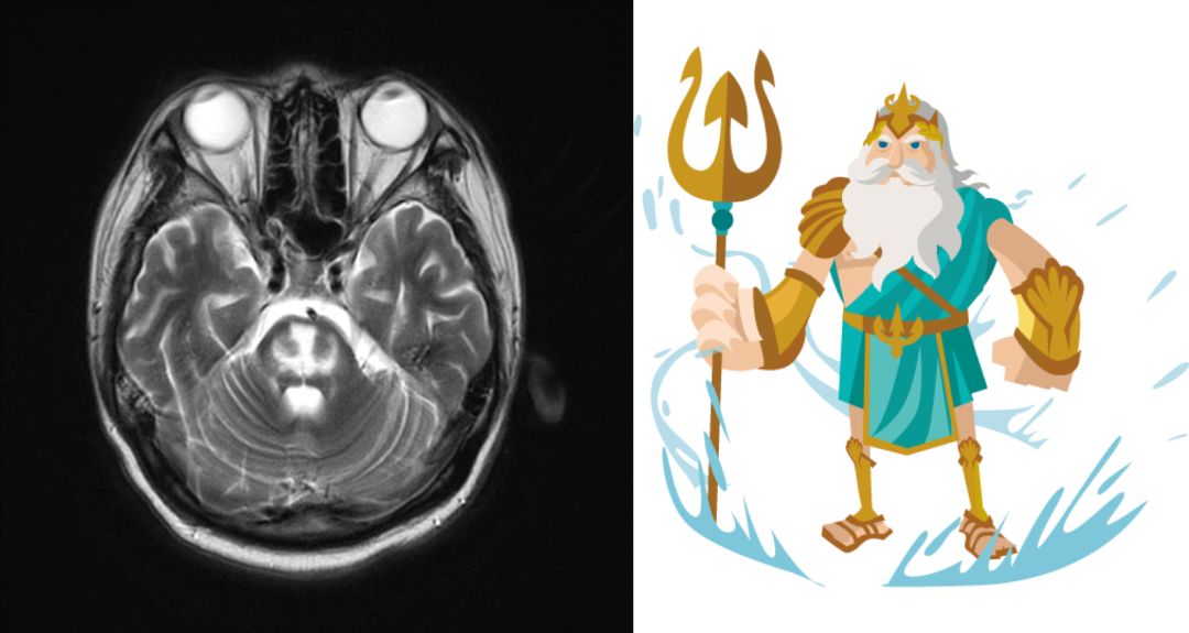 Interesting, "pig nose sign" and "trident sign" - iNEWS