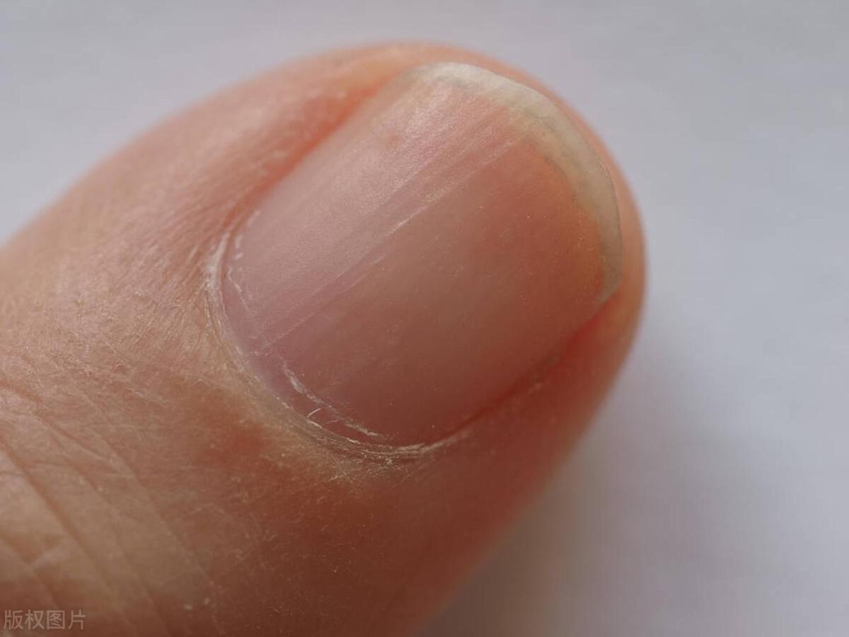 There are vertical lines on the fingernails, is the liver really bad ...
