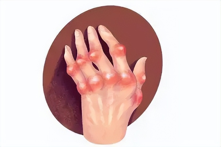 Beware of rheumatism when you are sore all over the body on rainy days ...