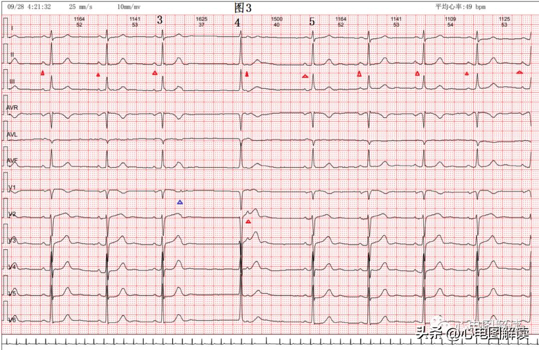 Long RR interval and its effects: atrial premature failure, junctional ...