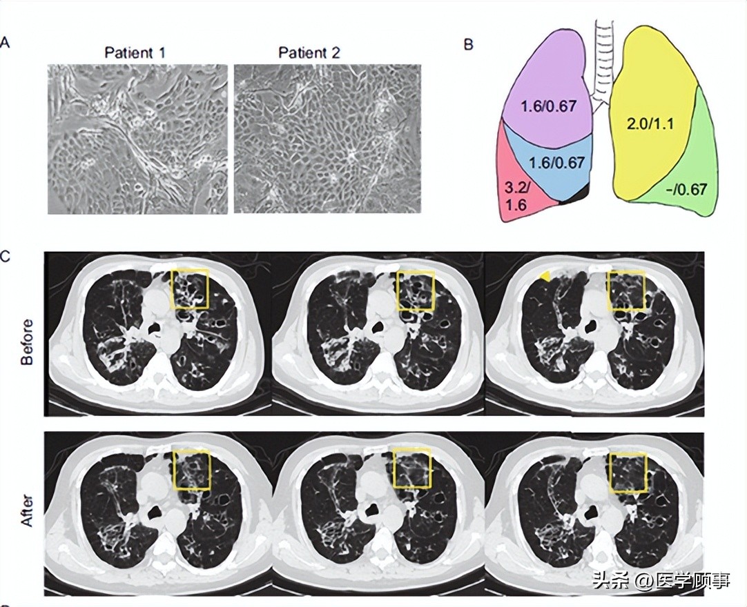 "Magic Bean" achieves human lung regeneration! Interview with Professor ...