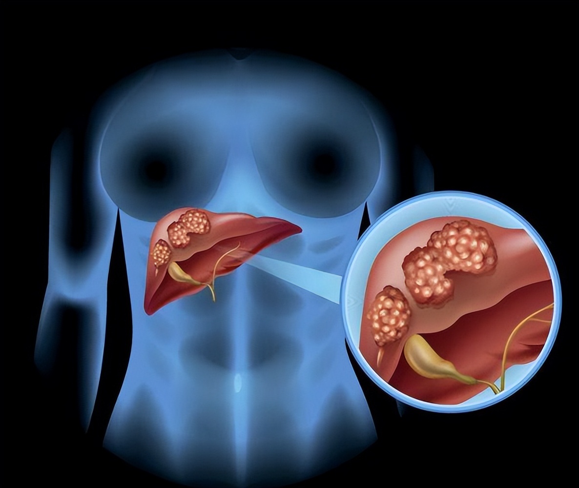 Regular early screening can disrupt the "trilogy" of liver cancer - iNEWS