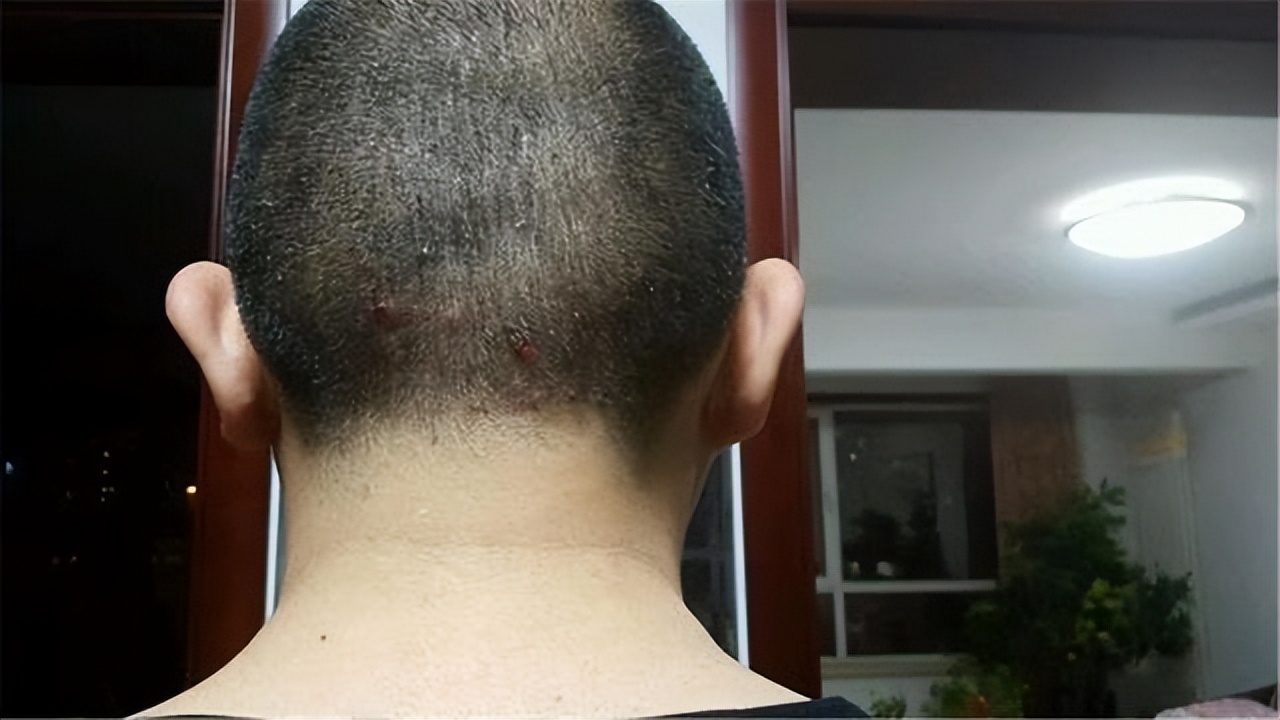 Pustules and pimples often grow on the scalp, what's the matter ...