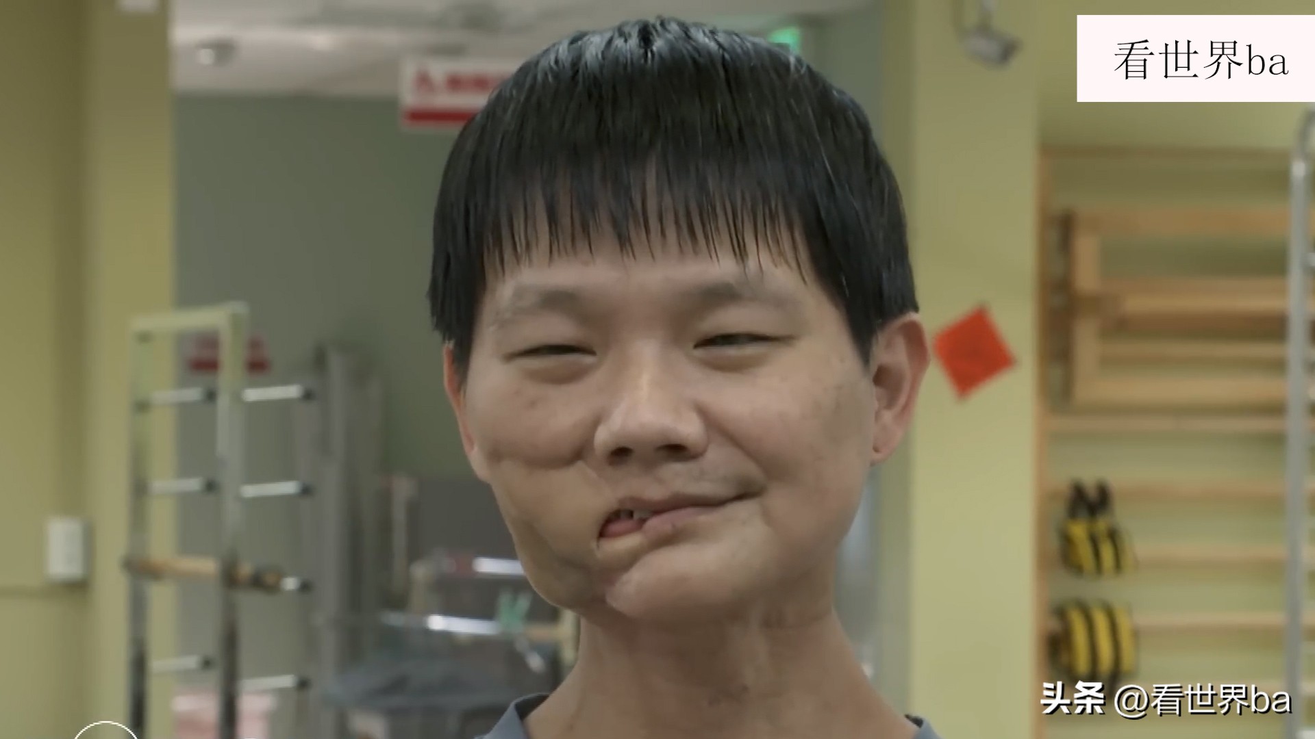 The male star chewed betel nuts for 6 years and suffered from oral ...