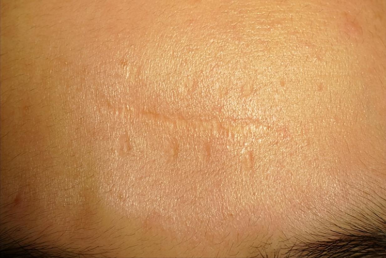 Can old scars be repaired? How to fix it effectively? - iMedia