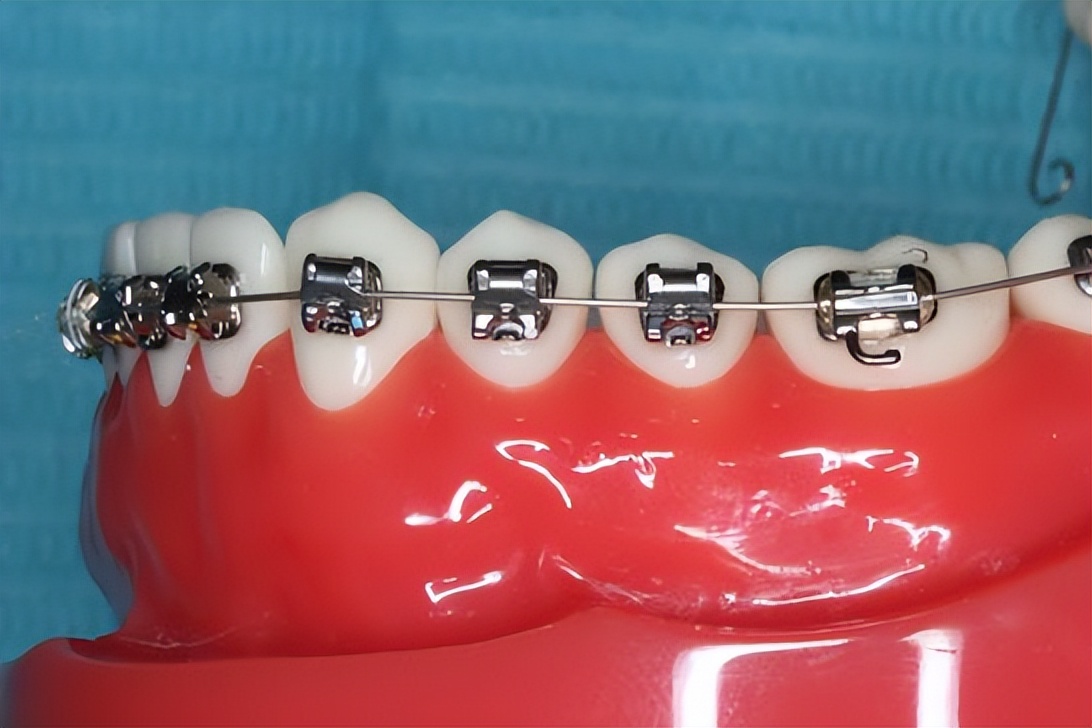 Is it better to wear steel braces or invisible braces to straighten ...