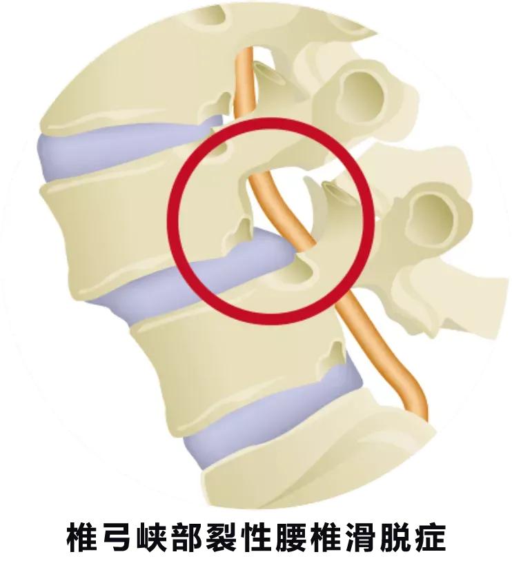 How is lumbar spondylolisthesis treated? - iNEWS