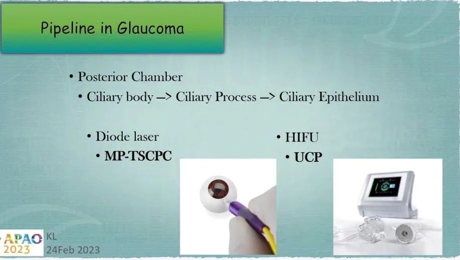 Research progress of glaucoma surgery based on ciliary process - iMedia