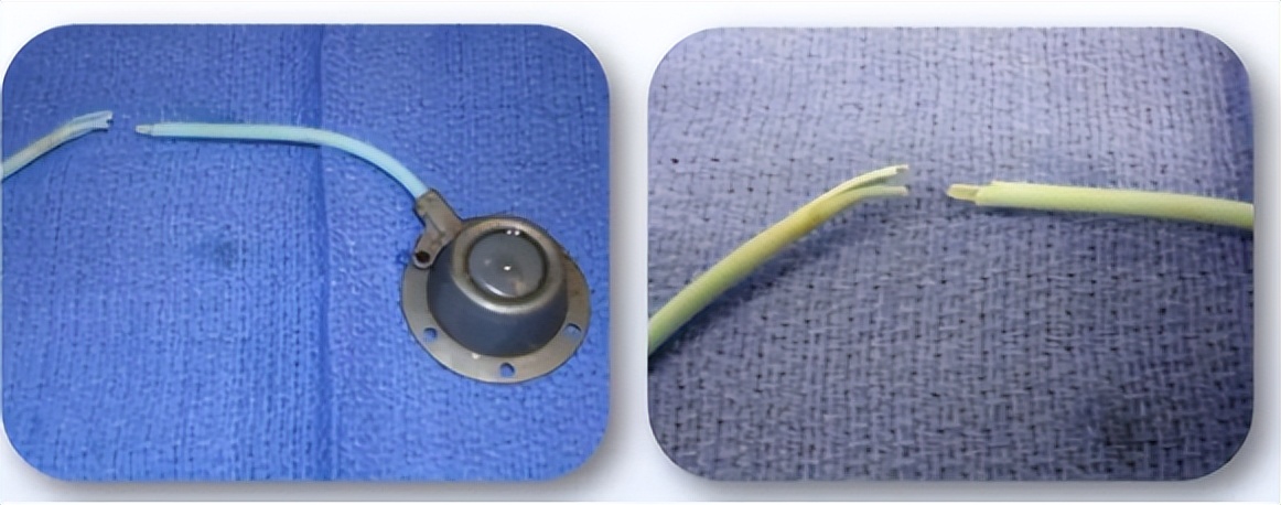 Is it safe for cancer patients to be placed in the infusion port?What ...