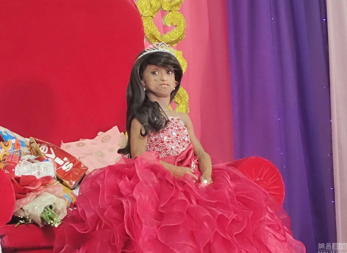 Filipino girl with progeria, Anna, 18 years old, close to 144 years old ...