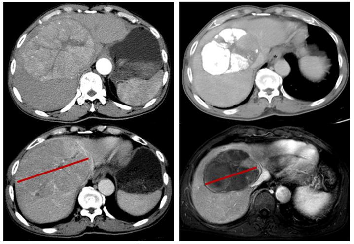 Professor Shi Ming: Application of FOLFOX HAIC in liver cancer ...