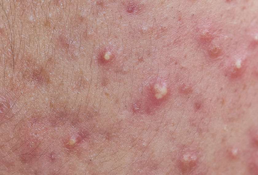 Study says facial mites and humans will merge?These 3 signs all ...