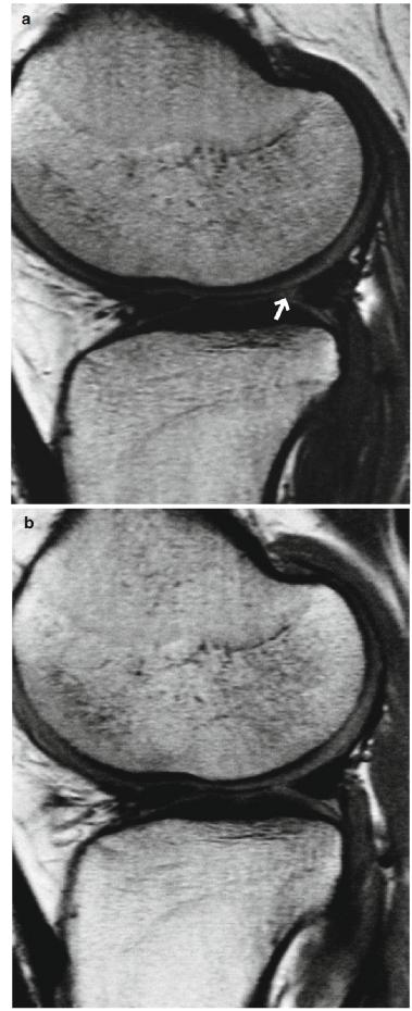 MRI appearance of postoperative meniscus - iNEWS