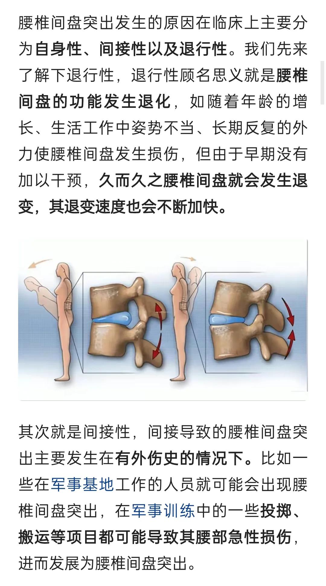 Lumbar muscle strain, lumbar intervertebral disc herniation compresses ...