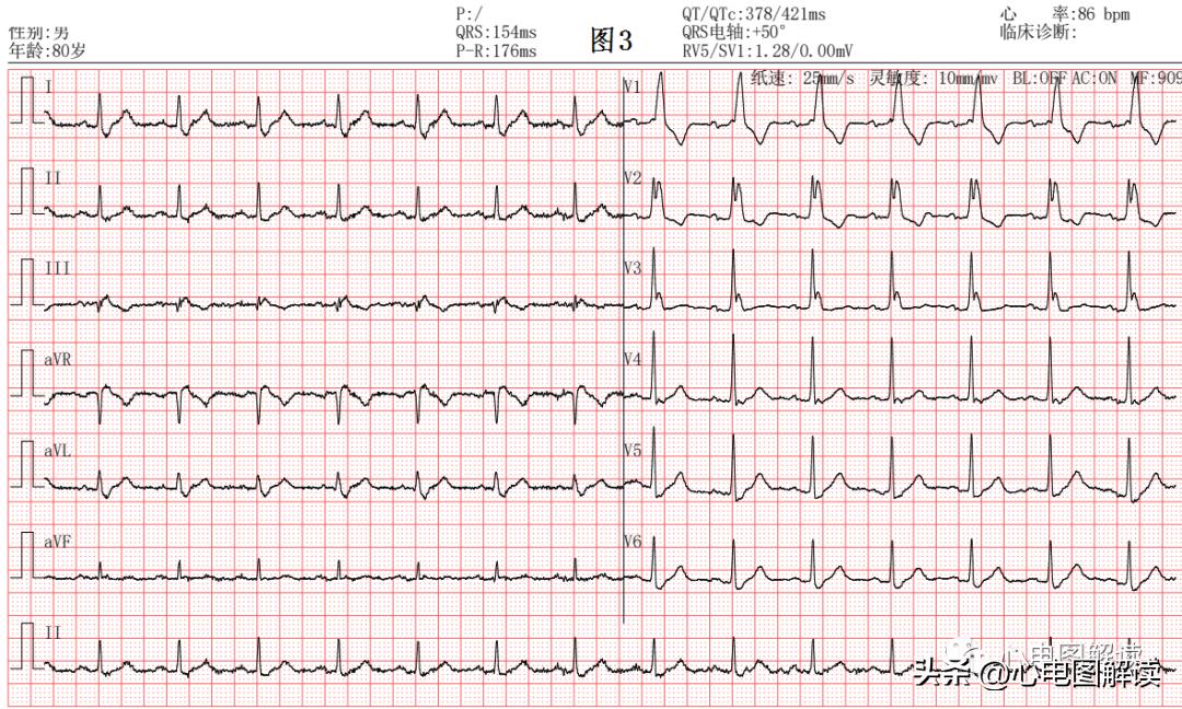 Complete right bundle branch block in 6 cases - iNEWS