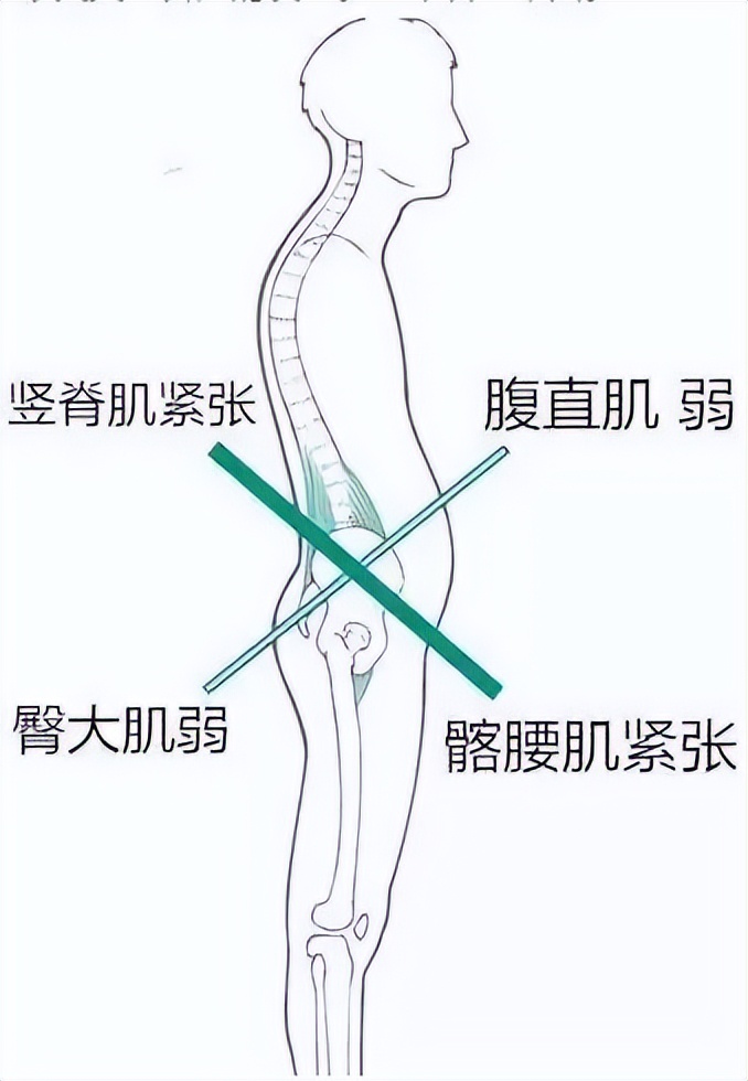 Butt weakness causing low back pain? Teach you 10 tricks to stimulate ...