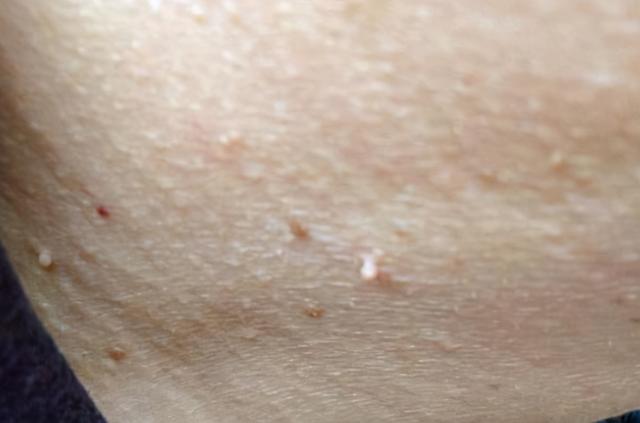 What are the "little meat particles" on the neck and underarms?Can it ...