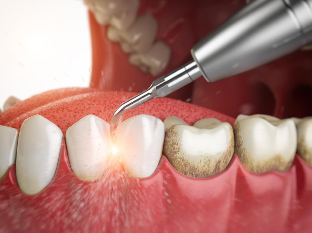 What are the side effects of subgingival scaling? Is gum recession an ...
