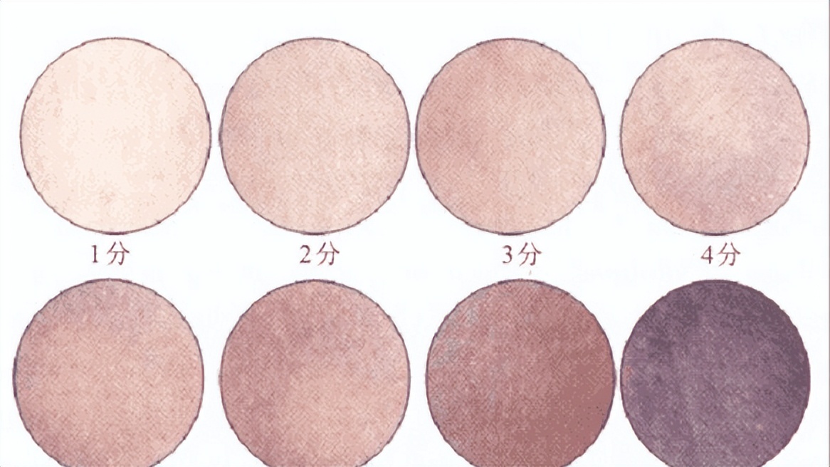 The darker the cupping marks, the more toxins and the worse the body ...