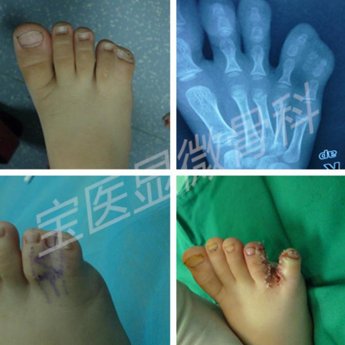 syndactyly - iNEWS