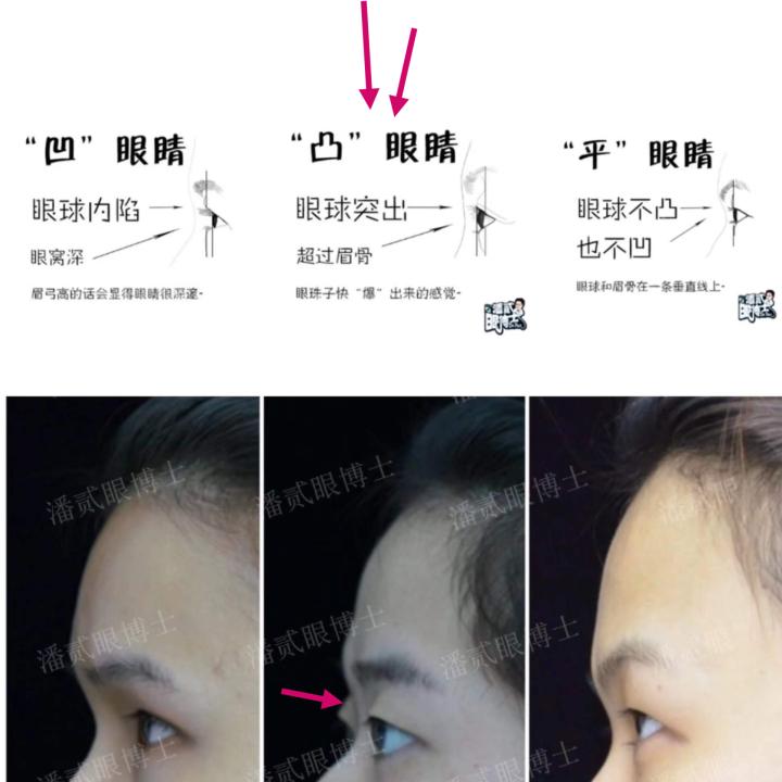 People with protruding eyes: Protuberance, sunken upper eyelid or ...