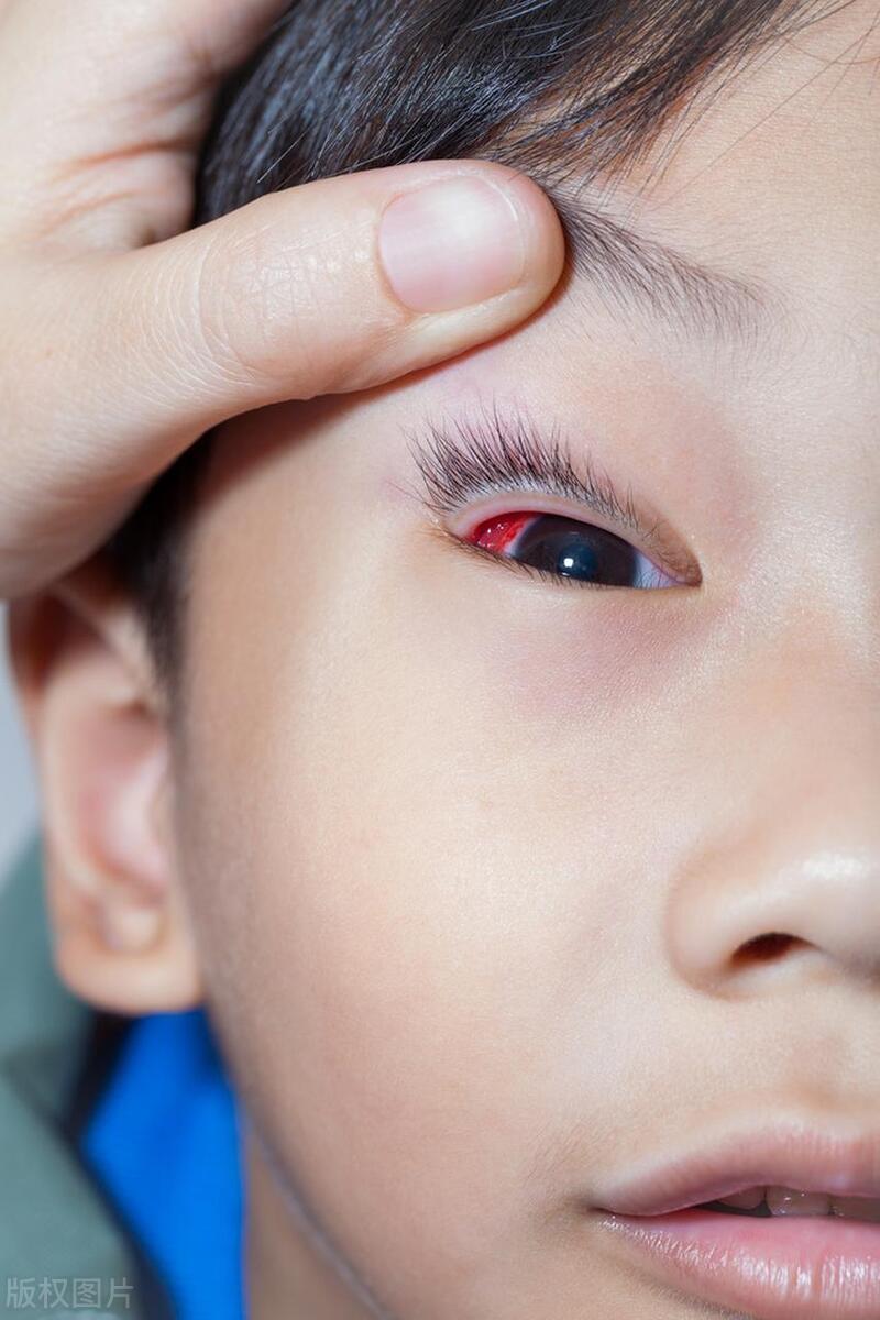 What are the causes of red eyes in children after swimming? How to deal ...