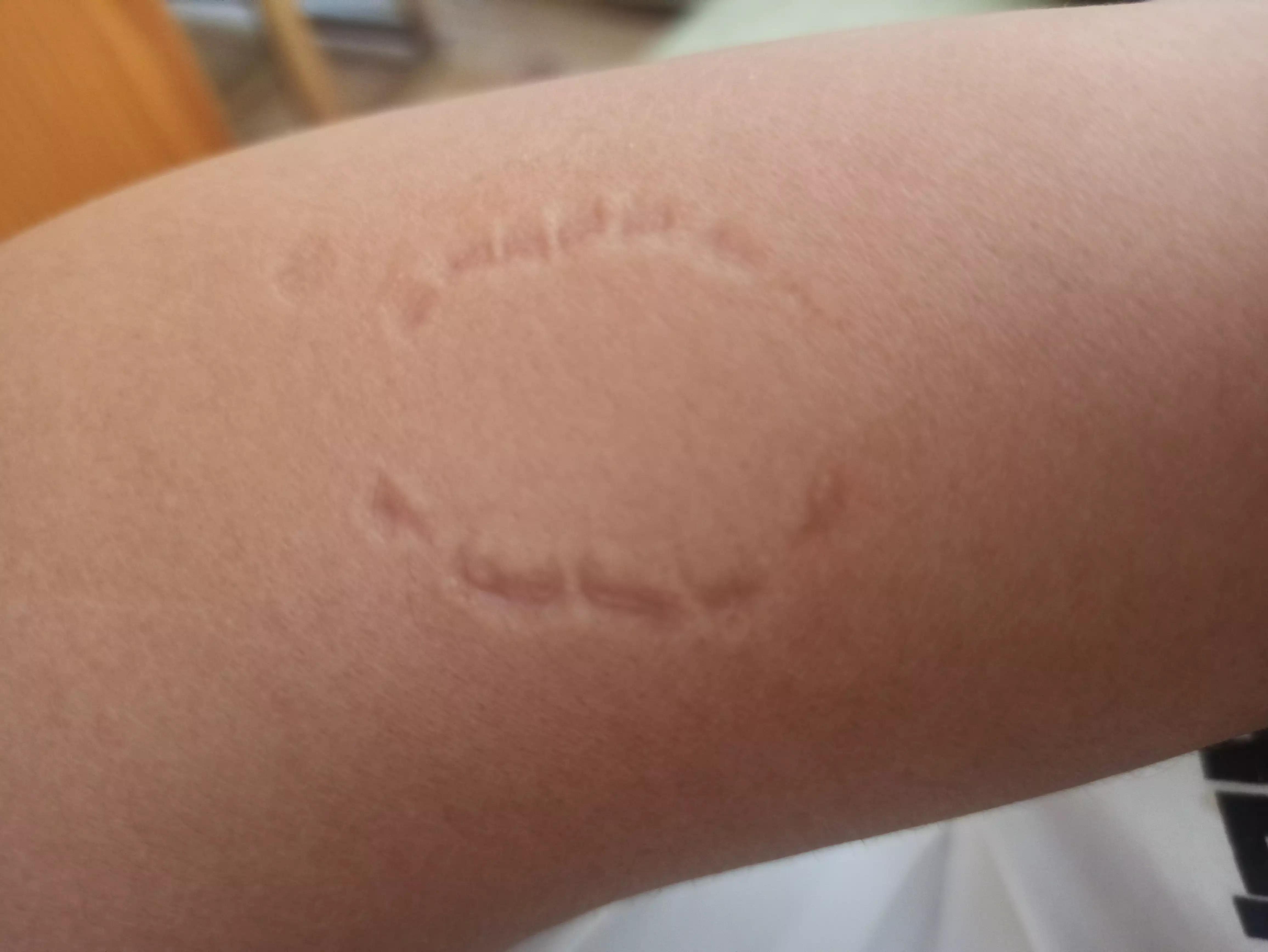 child's tooth marks - iMedia