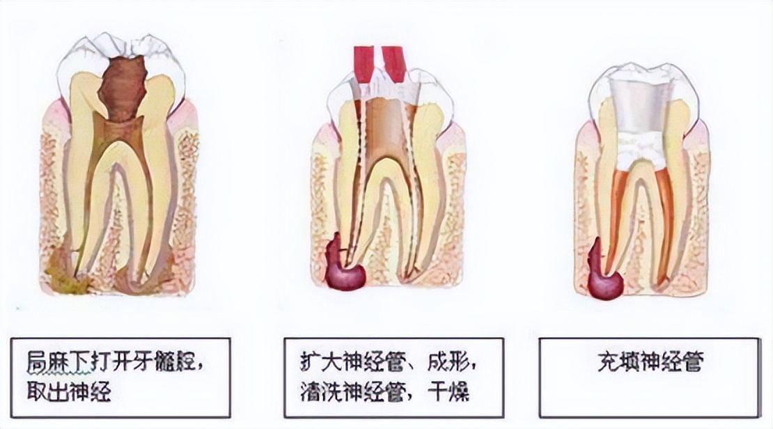 In one minute, let you understand what "root canal treatment" is - iNEWS
