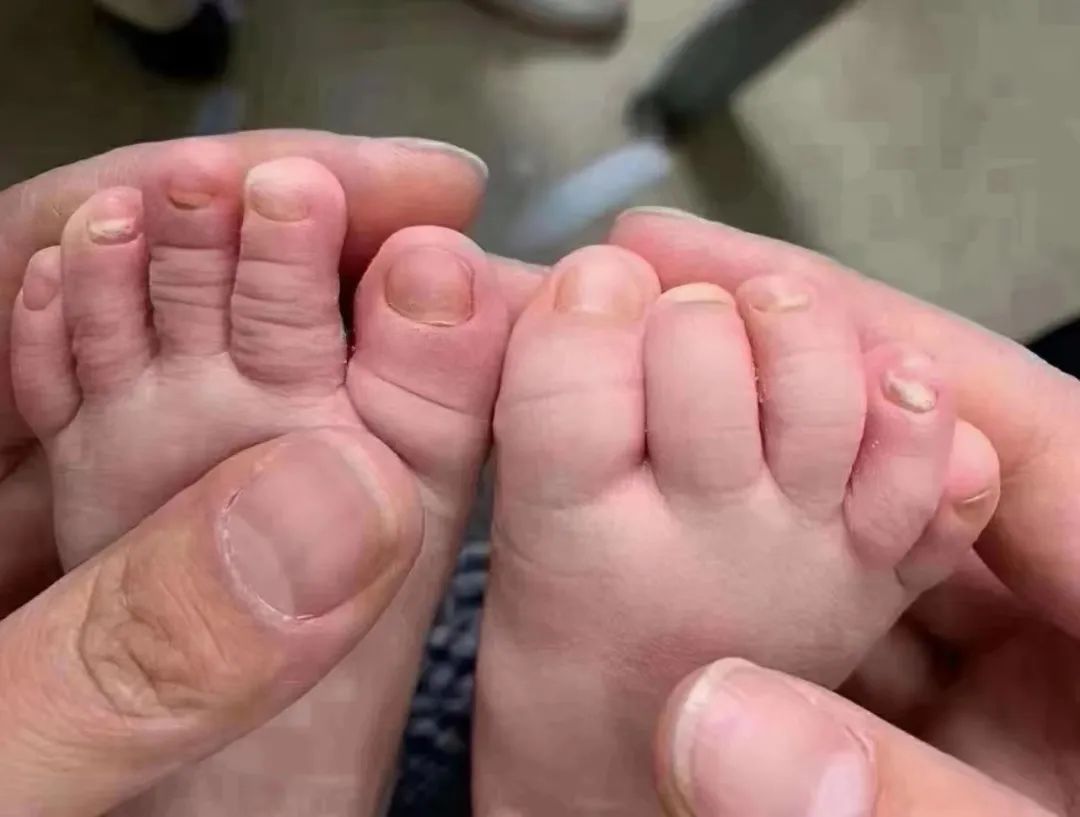 1-year-old 8-month-old child has nail fungus!It had something to do ...
