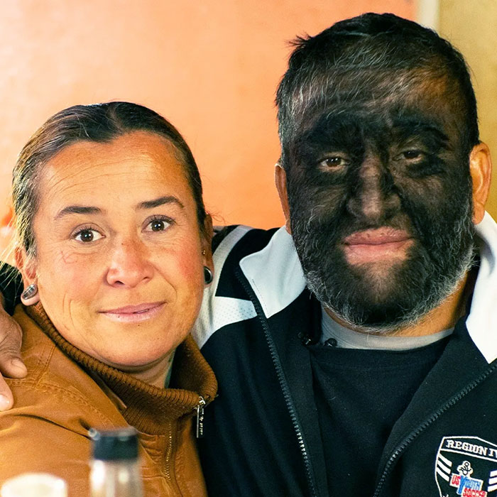 20 Humans With Rare Genes, There Are So Many Unique Humans In The World ...