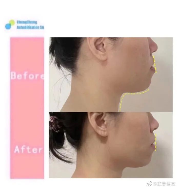 The face looks old and rustic! "Nose base depression + moon face" - iMedia