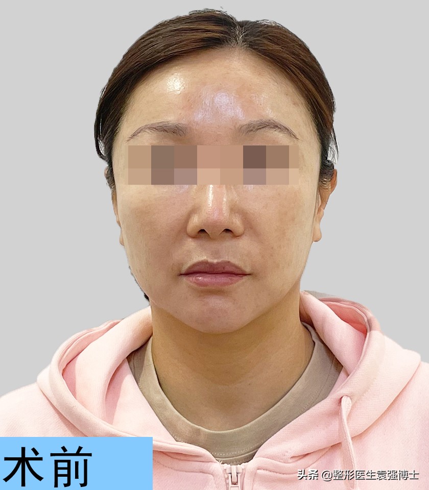 At 47 years old, I had a small temporal facelift + facetite. I was ...