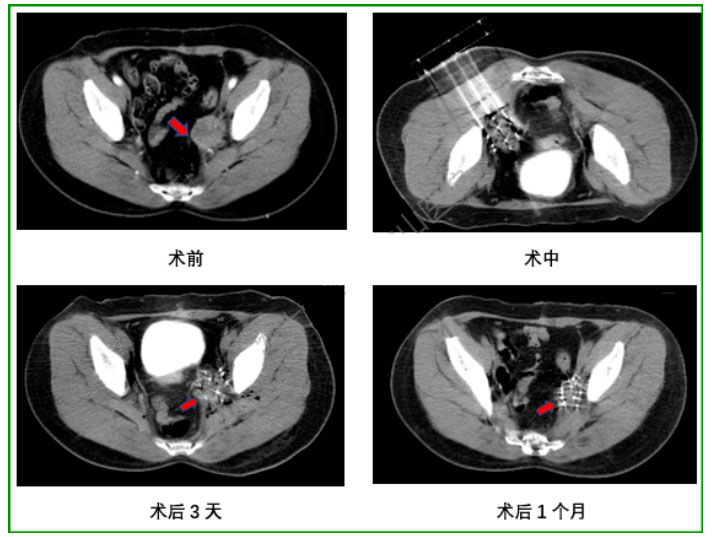 A New Method of Tumor Treatment-Radioactive Seed Implantation Therapy ...