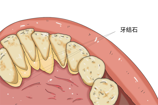What is the smelly "yellow mud" on the teeth?How to remove it?tell you ...