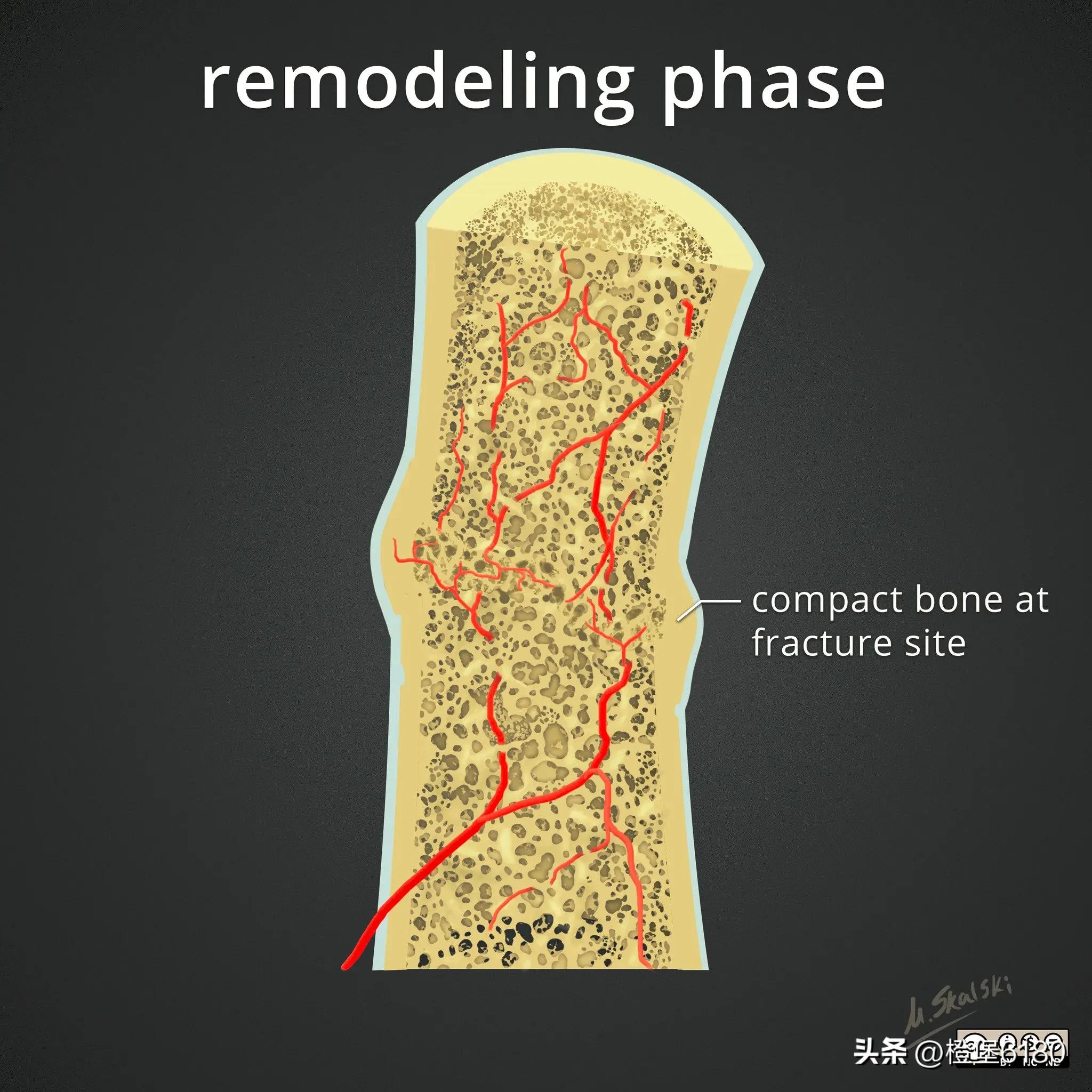 fracture healing process - iNEWS