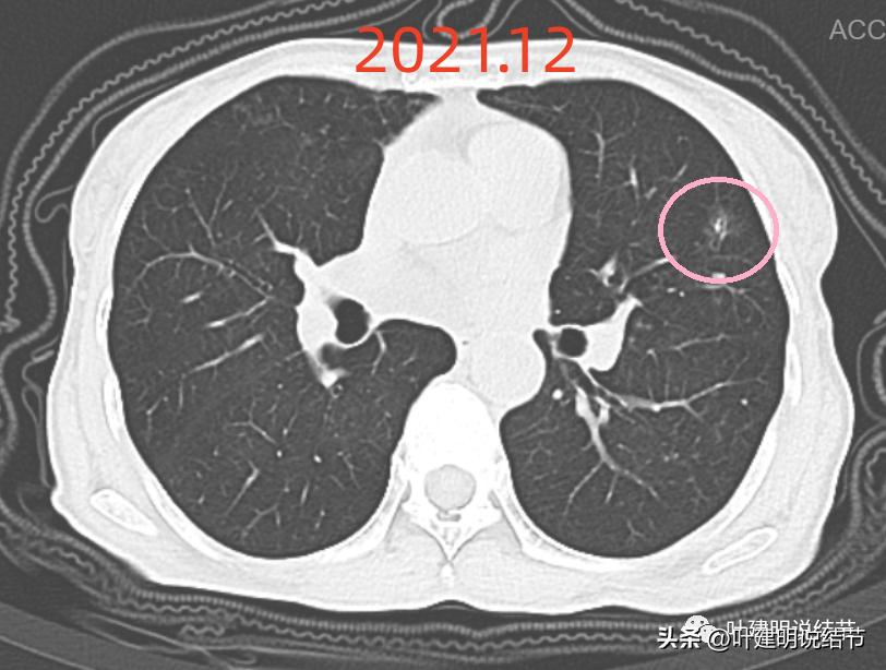 Multiple ground-glass nodules have progressed during follow-up, should ...