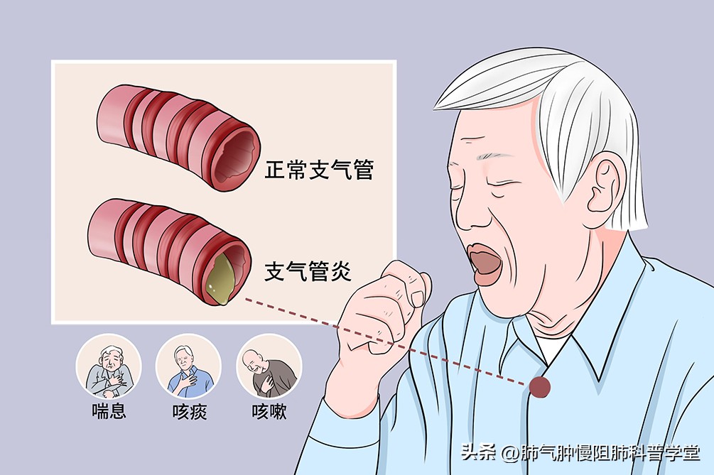 What are the symptoms of acute bronchitis? 8 major symptoms are very ...