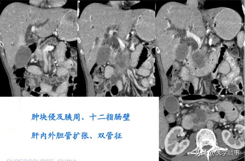 Imaging manifestations and differential diagnosis of ampullary ...