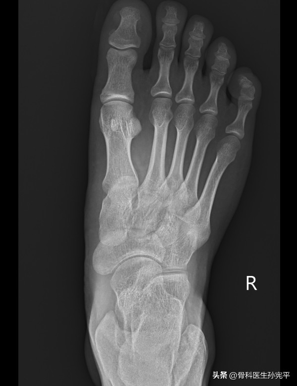 Sharing of Medical Imaging Pictures (31) - Outer Tibia/Scaphoid ...