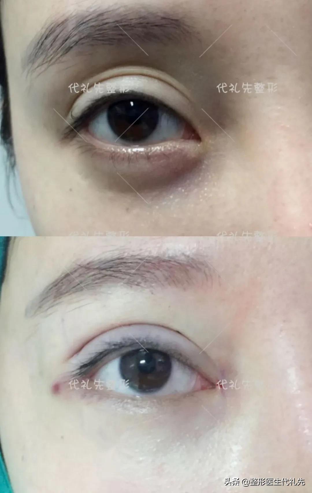 After the sunken eye socket is filled, the eyes change - iNEWS