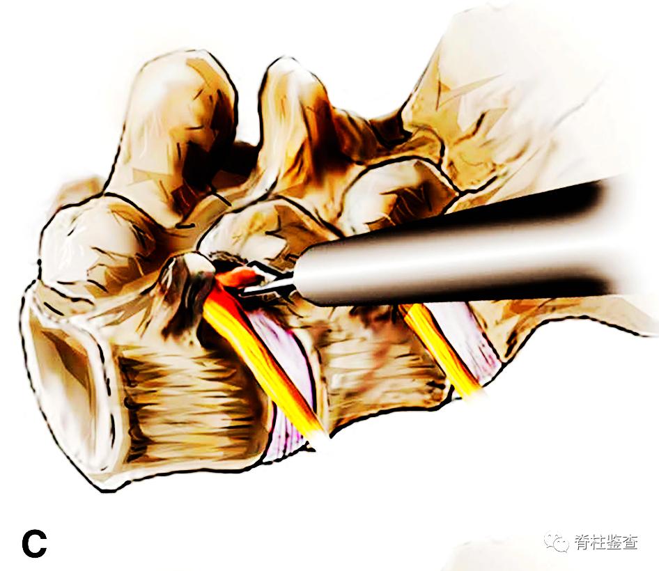Percutaneous endoscopic lumbar foraminotomy decompression: what to do ...