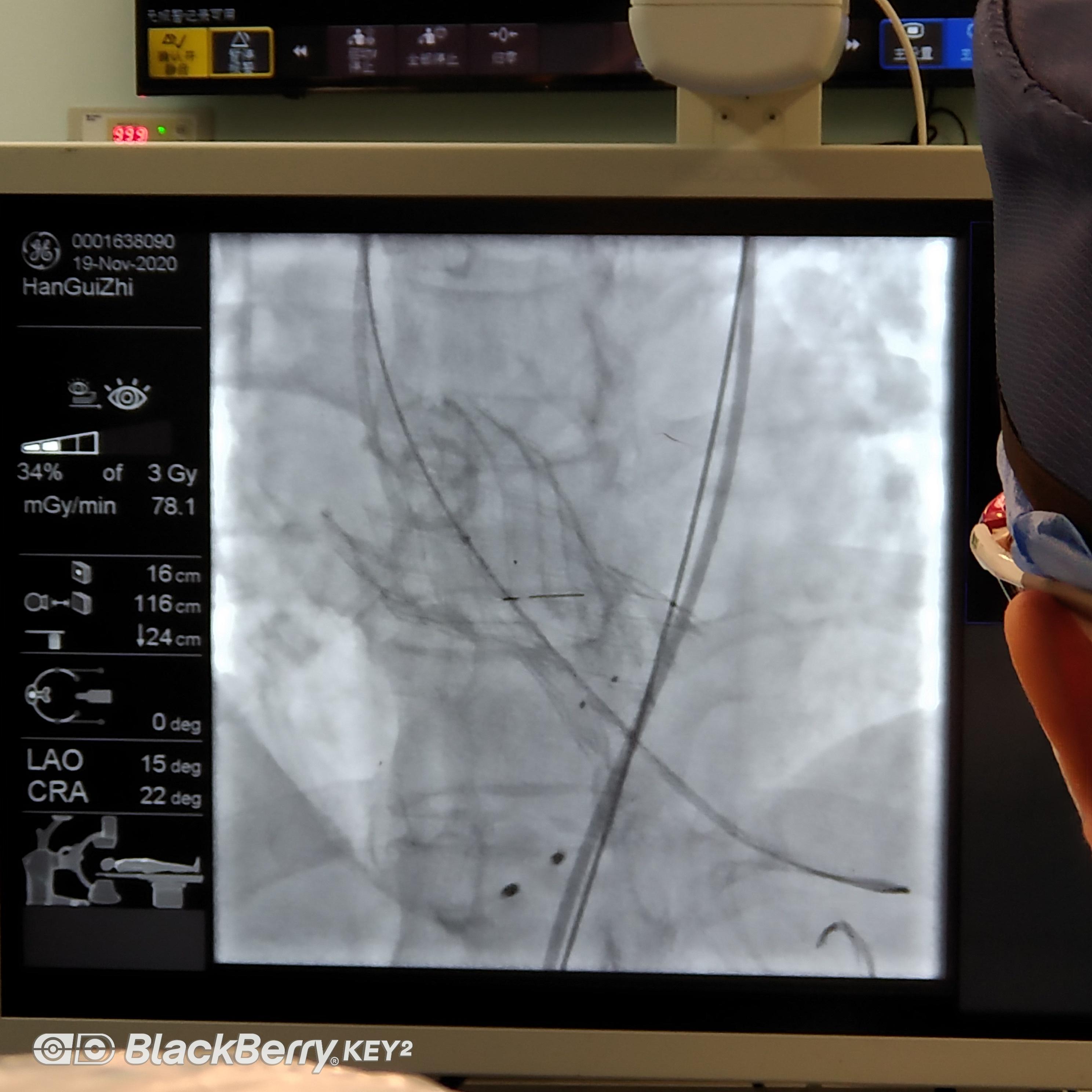 An anesthesia monitor who has experienced 100 TAVRs, personal ...