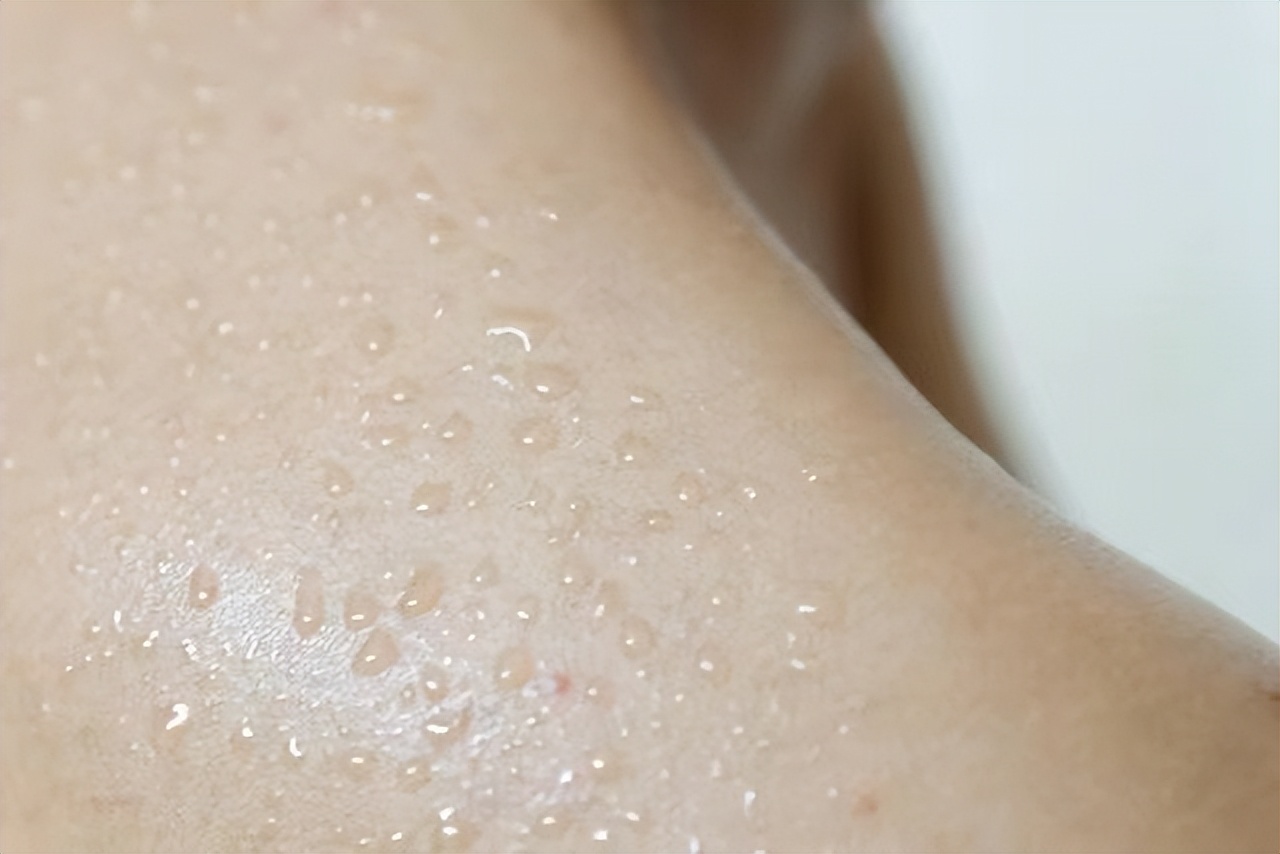 Sweat is the "barometer" of the body, 4 kinds of abnormal sweating, or ...